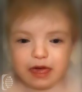 3C Syndrome (Ritscher-Schinzel Syndrome) OMIM# 220210 - FDNA