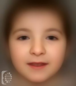 Rubinstein-Taybi Syndrome OMIM# 180849 - FDNA