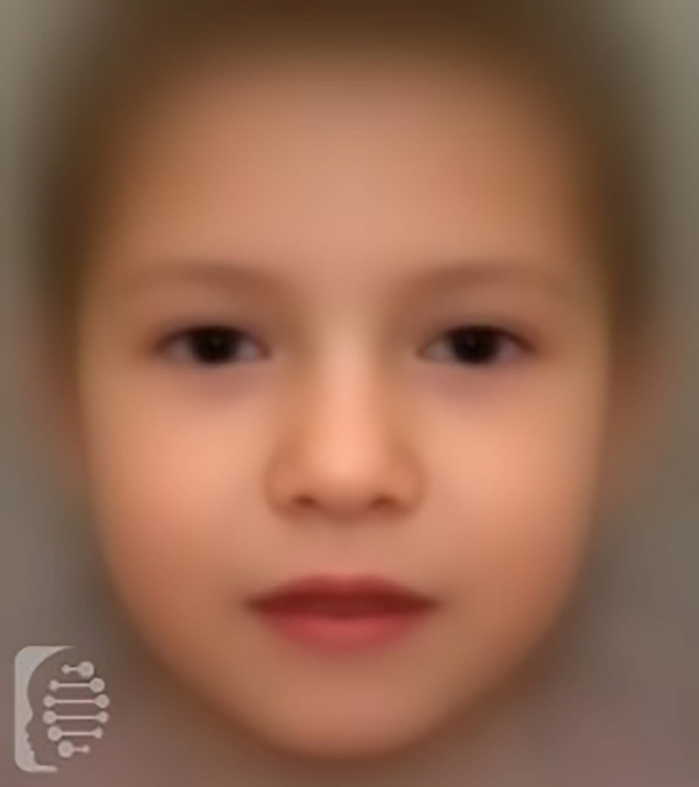 FDNA™ 22q11.2 Deletion Syndrome: Symptoms, Causes, and Diagnosis