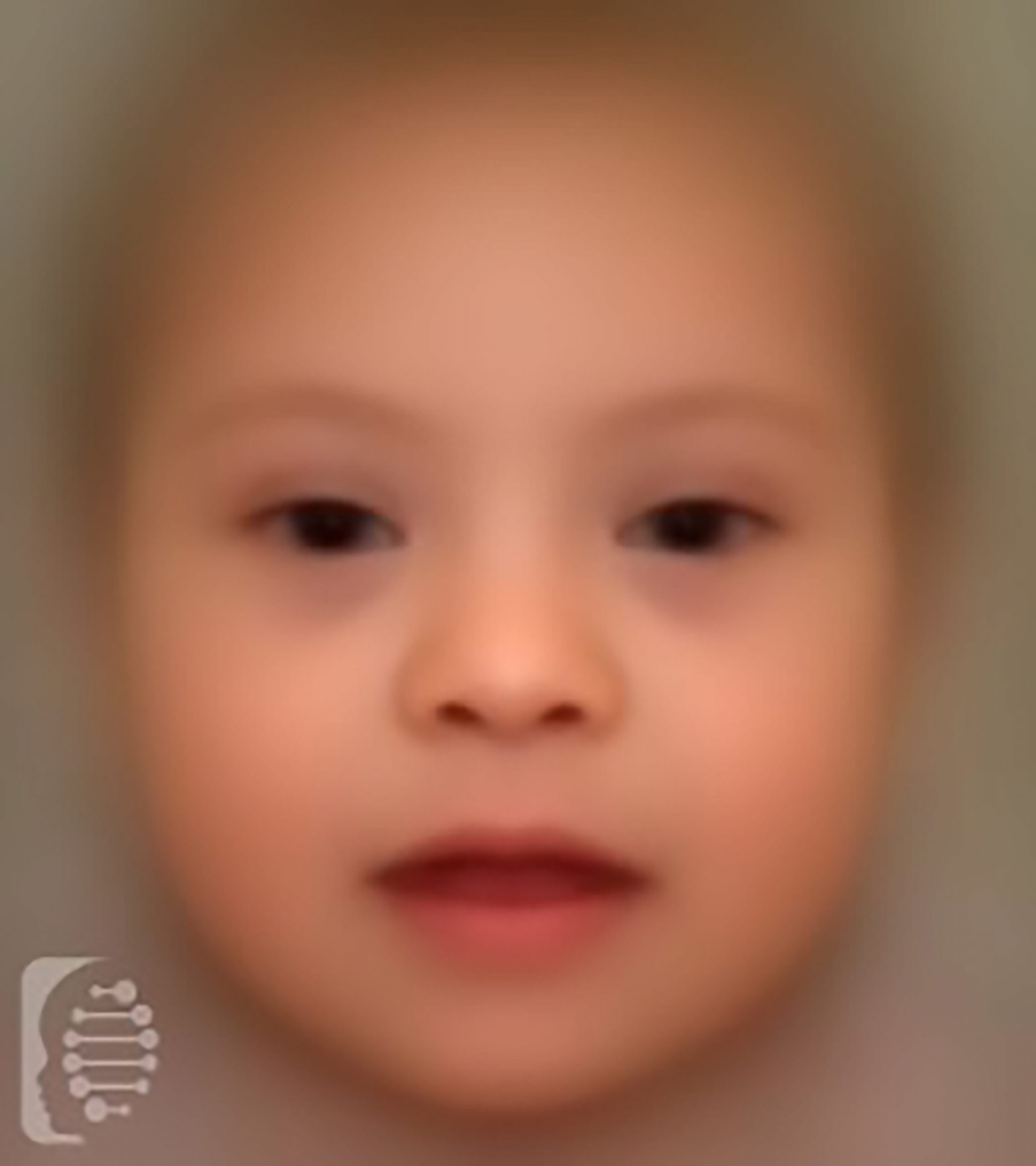 Upslanting Palpebral Fissures Syndrome