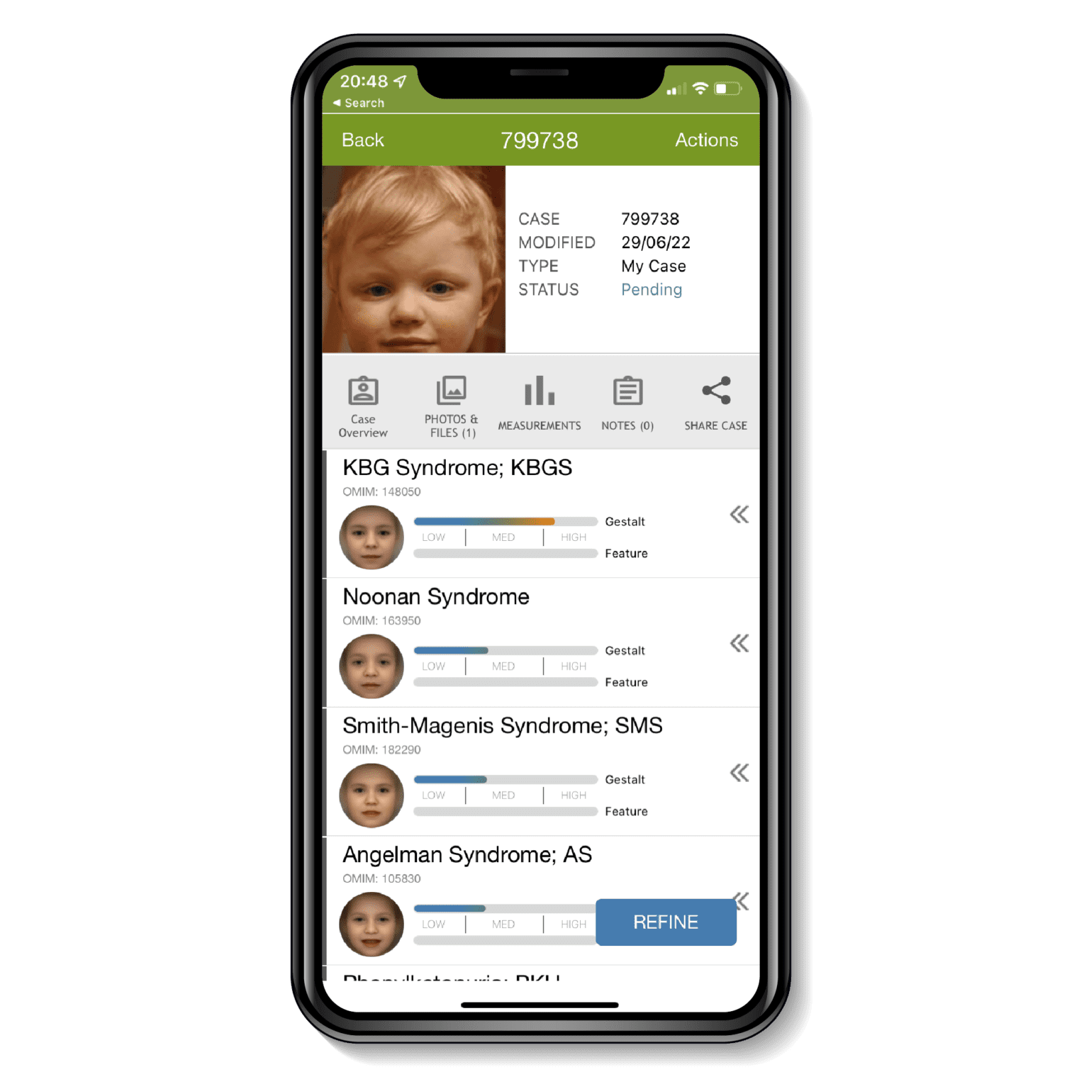 FDNA™ - Navigating the Diagnostic Odyssey: Bug's Story of KBG Syndrome